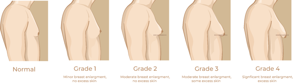 Gynecomastia Surgery in Nepal : By Nepal’s top breast surgeons, Dr ...